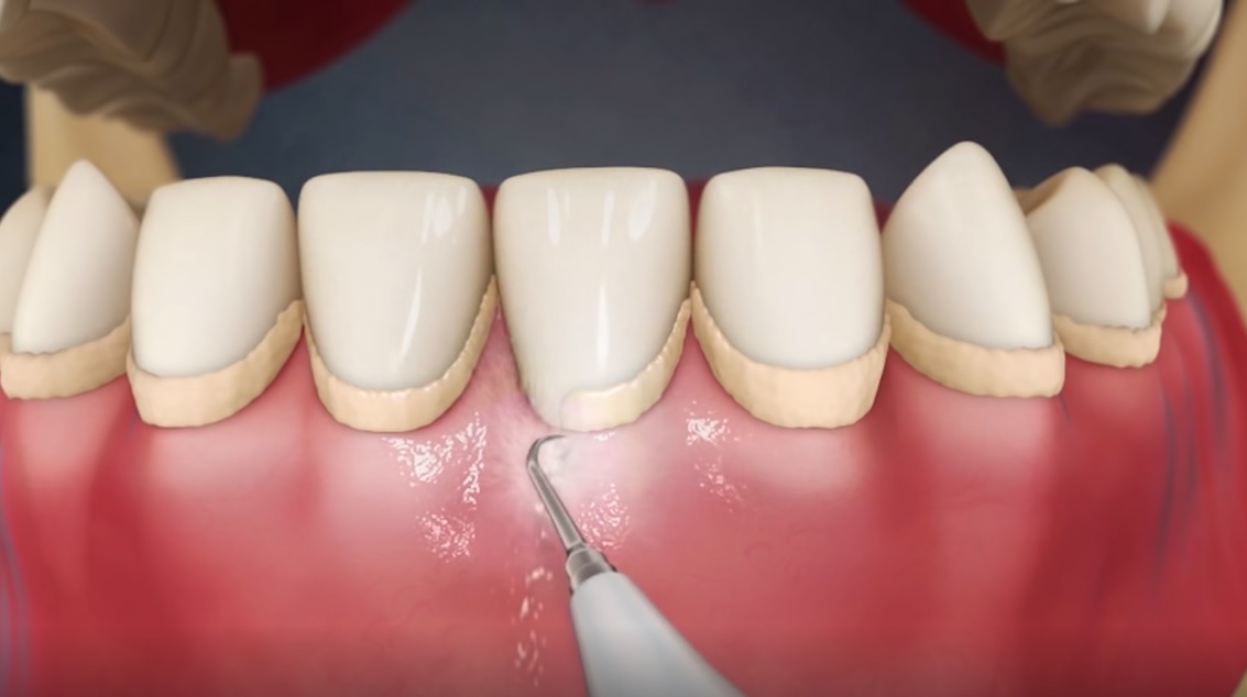 The Serious Outcome of Tartar Formation on Teeth - Doctor Monther Numan ...