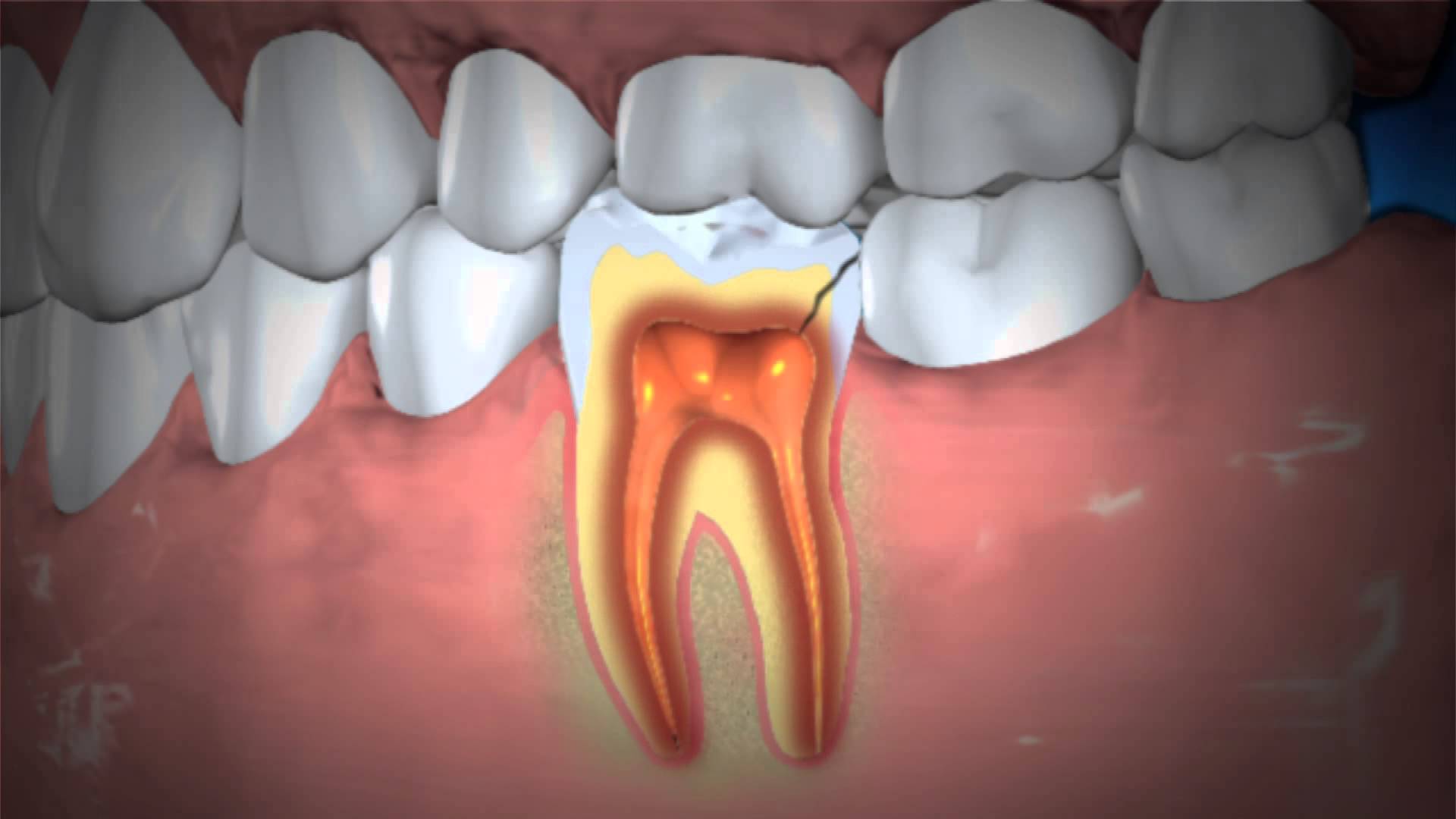 What is Tooth Abscess? - Doctor Monther Numan Dental Clinic