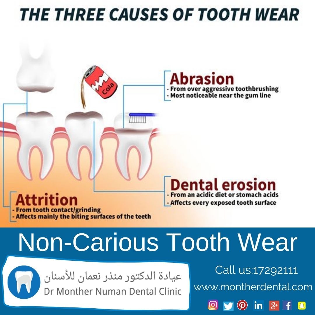 Tooth Wear - Doctor Monther Numan Dental Clinic