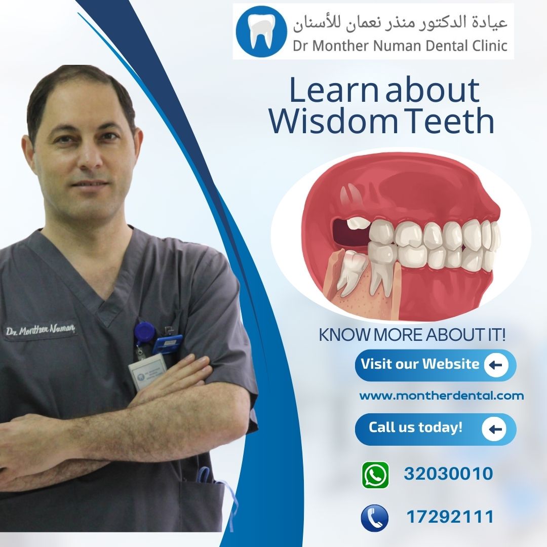 Learn About Wisdom Teeth - Doctor Monther Numan Dental Clinic